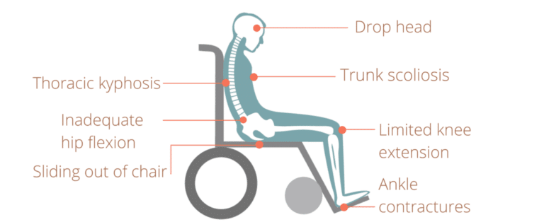 4 Steps to Prevent Sliding Forward From in a Wheelchair - Clinics Can Help